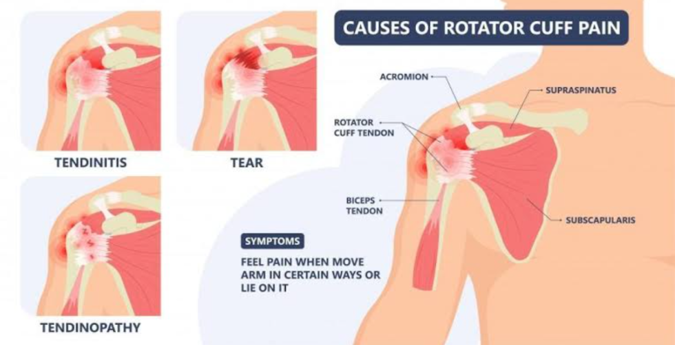 Pernahkah Anda Mendengar Nyeri Rotator Cuff? Yuk, Simak Penjelasannya